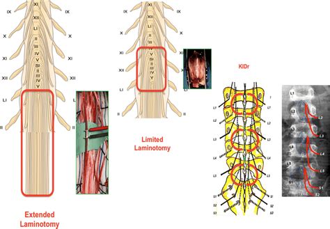 Rhizotomy Meaning Intra Operative Photomicrographs During A