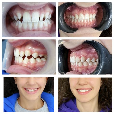 Алайнери Invisalign или брекети Как да изберем