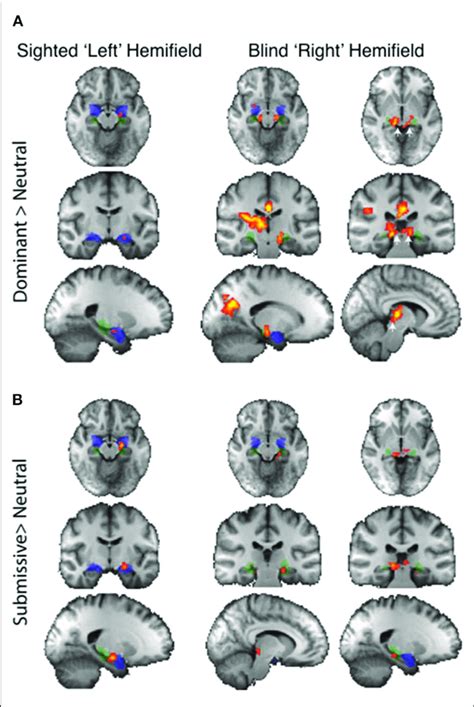 Fmri Preference For Dominance Traits Neutral In Patients With Download Scientific Diagram