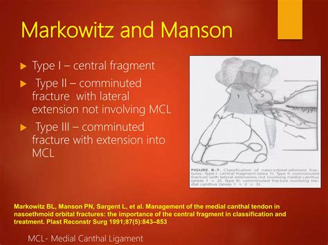 Classification Facial Fracture Current Concept Pptx