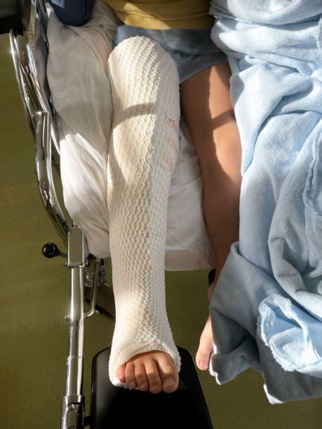 Broken Femur Cast
