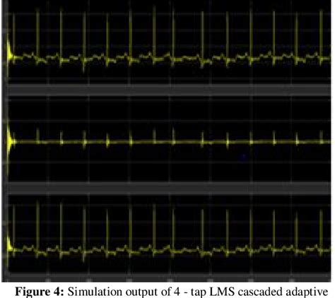 Figure 1 From Design Of Cascaded Adaptive Filter For Ecg Denoising