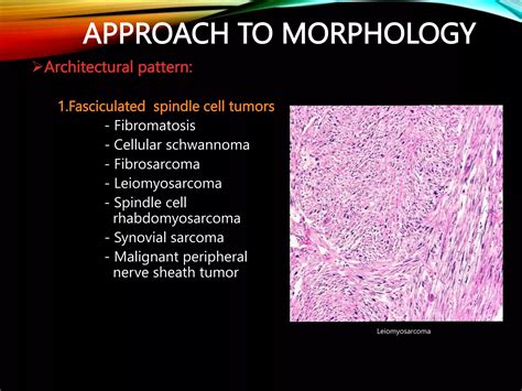 An Approach To Diagonosis Of Soft Tissue Sarcomapptx