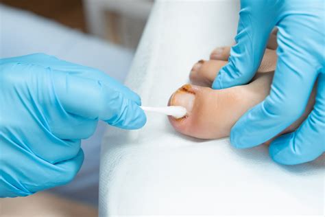 Thick Toenails Causes Home Remedies And Podiatric Care The Foot Practice
