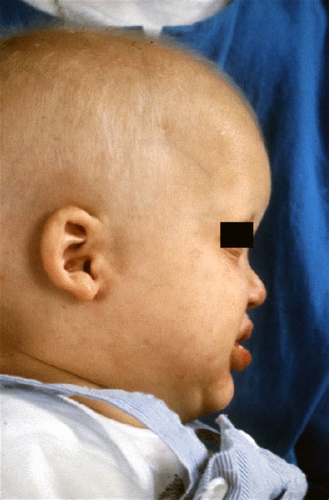 Ectodermal Dysplasia Ectodermal Defect Congenital