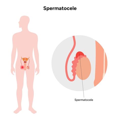 Testicular Spermatocele