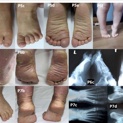 Patients 5 7 With Autosomal Recessive Congenital Ichthyosis Collodion Download Scientific