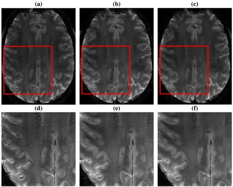 Compressed Sensing Mr Image Reconstruction Parietal
