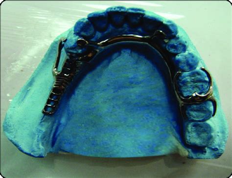 Metal Framework Of Mandibular Partial Denture Download Scientific Diagram