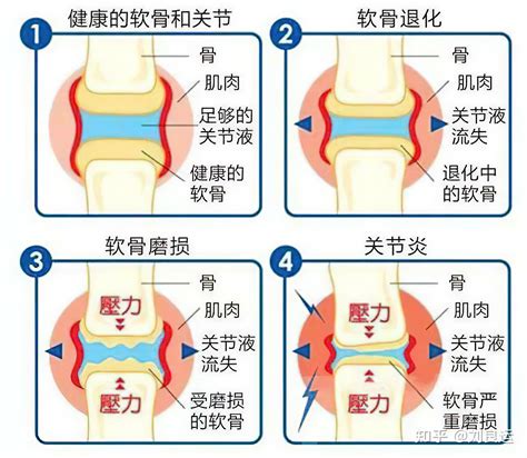哪些原因会导致膝关节退变退变初期如何保护膝关节缓解疼痛 知乎