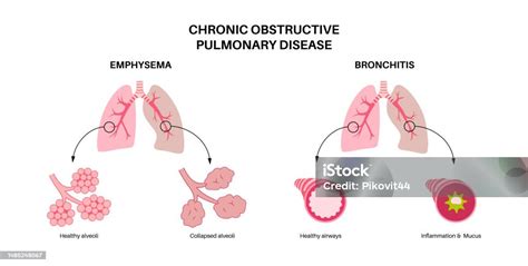만성 폐쇄성 폐 질환 폐기종에 대한 스톡 벡터 아트 및 기타 이미지 폐기종 건강관리와 의술 건강한 생활방식 Istock