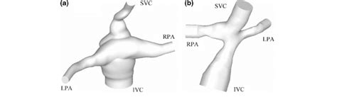 Geometries Of The Two TCPC Anatomies Retained For This Study A Model Download Scientific