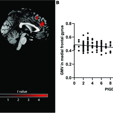 A Voxel Based Morphometry Showing Smaller Gmv In Medial Frontal Gyrus