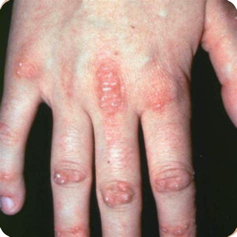 Dermatomiosite Dra Clarice Moura