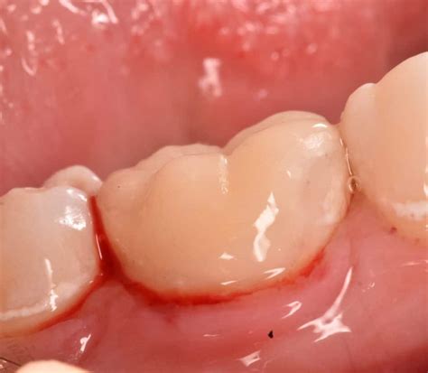 Lithium Disilicate Overlay Myzerodonto