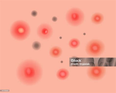 여드름 다이어그램의 종류 스킨 케어 문제 및 염증 여드름 피부 유형 여드름 화이트 헤드 구진 농포 낭성 및 결절성 피부에 대한