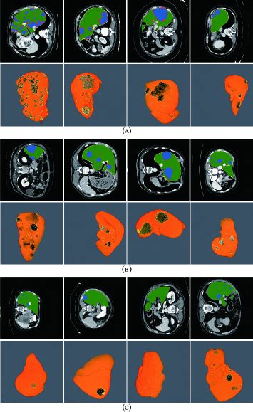 [1811 01328] Ra Unet A Hybrid Deep Attention Aware Network To Extract Liver And Tumor In Ct Scans