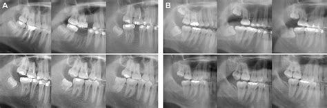 Vertical Eruption Of The Third Molars After Protraction Of The