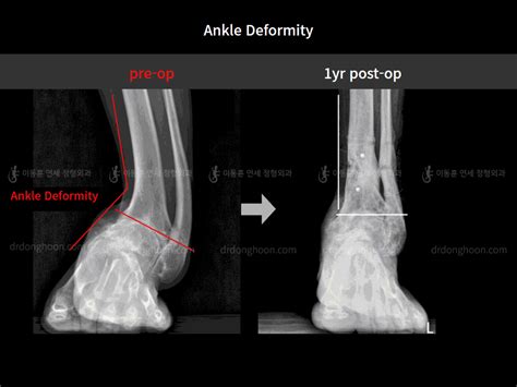 Ankle Deformity Foot And Ankle Deformity