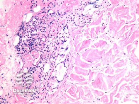 Cryptococcus Histology