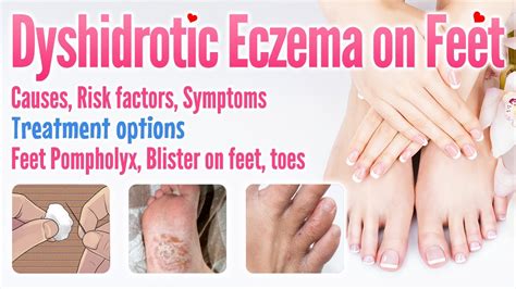 Dyshidrotic Eczema On Feet