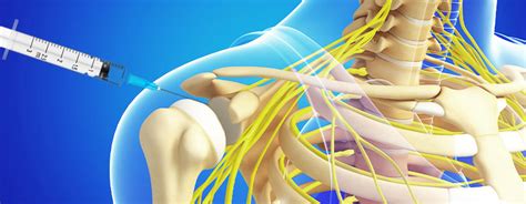 Subacromial Injections Fort Worth Subacromial Injections For Auto Accident Injuries