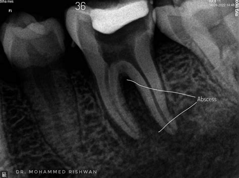 Dr Mohammed Rishwan On Linkedin Rct