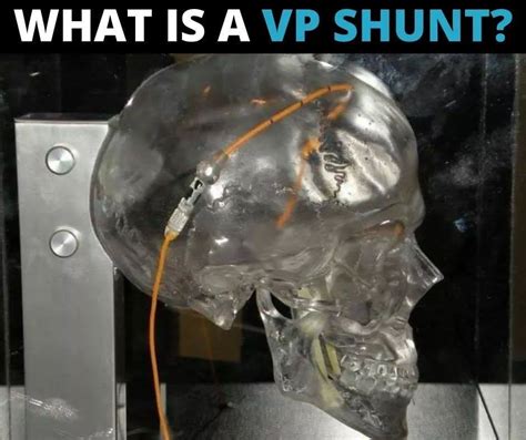 What Is A Shunt 16 A Ventriculoperitoneal Vp Shunt Is A Medical