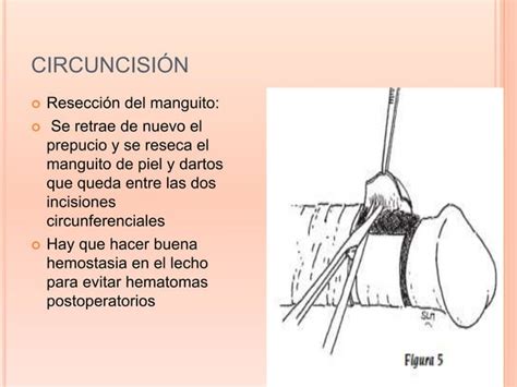Técnica Quirúrgica Circuncisión Pptx Surgery Medical Health