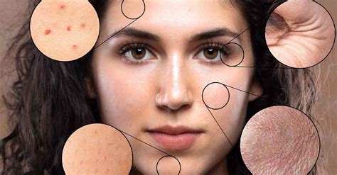Skin Pigmentation Types Causes And Treatment Dr Pavithra Hn