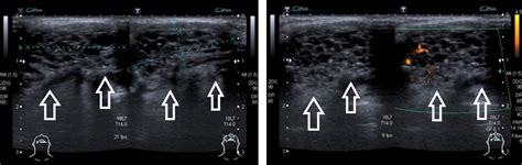 Diagnosis Of Ectopic Thyroid Gland By Scintigraphy