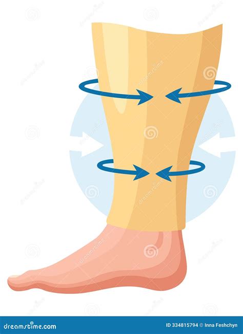 Stages Of Varicose Veins Disease Infographic Cartoon Vector