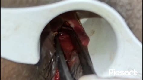 Nima Gyana Ganga 3 Bhagandara Part 1 Case By Dr Dipu Sukumar Bsc Bams Ms Shalya Youtube