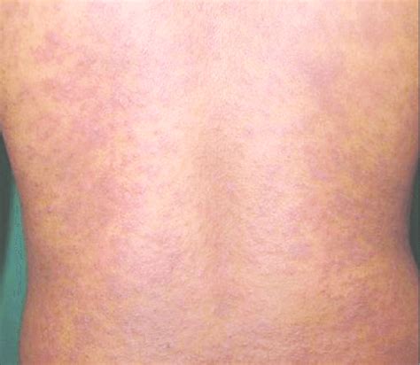 Resolving Rash Of Drug‑induced Pityriasis Rosea At The End Of 1 Week Download Scientific