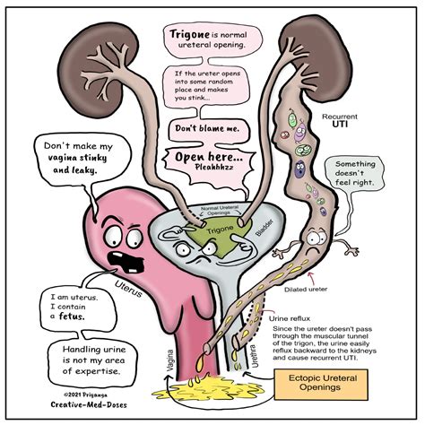 Ureterocele Ivp 5951