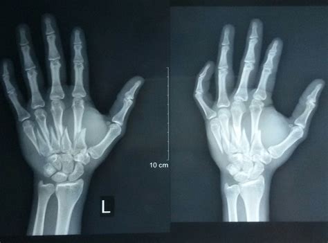 VIDHUNS PLASTIC SURGERY AND COSMETIC WORLD Metacarpal Fracture