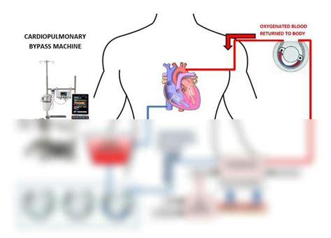 Solution Cardiopulmonary Bypass Machine 2 Studypool