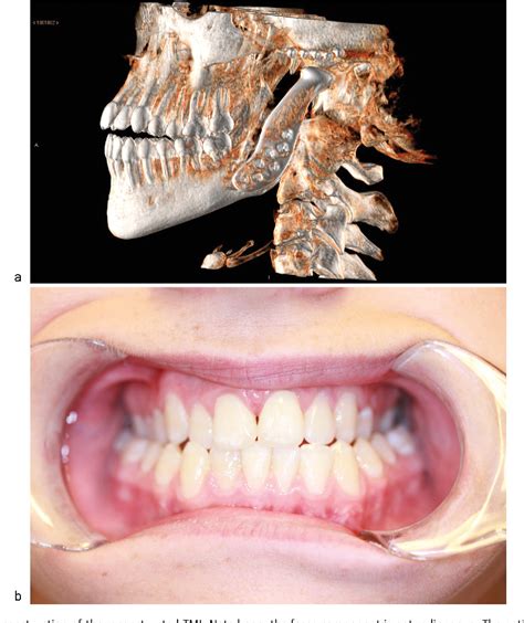 Figure 2 From A Case Of Glenoid Fossa Fracture Progressive Ankylosis Total Joint