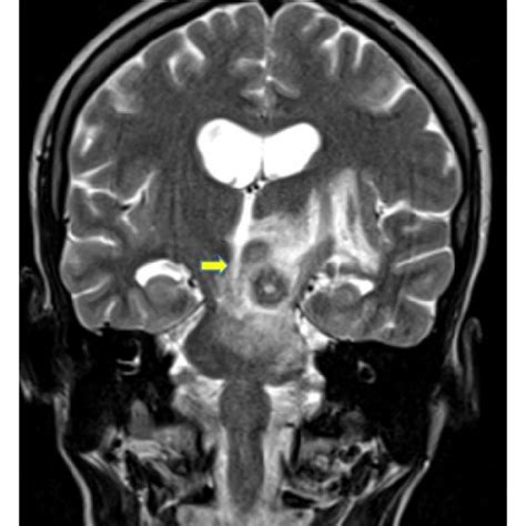Tuberculoma In The Left Pedunculus Cerebri At Time Of First Encounter