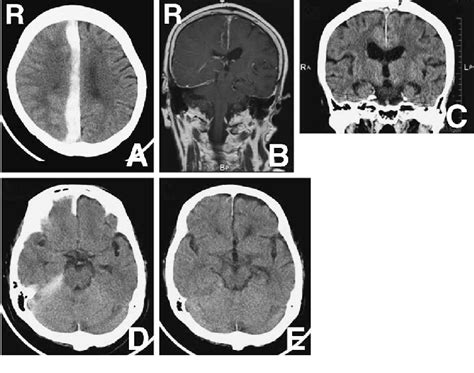Axial Head Computed Tomography Ct Scans On Admission Showing A Download Scientific Diagram