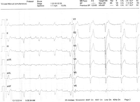Trifascicular Block Progressing To Complete Av Block On Exercise A Rare Presentation
