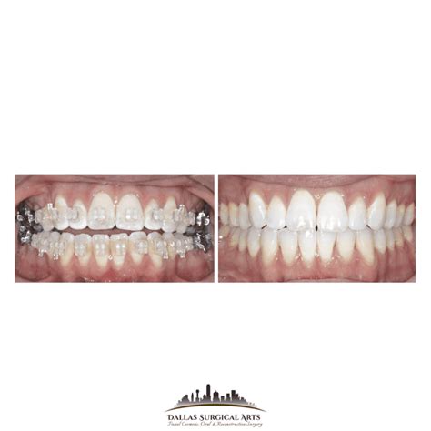 Jaw Repositioning Orthognathic Surgery Dallas Surgical Arts