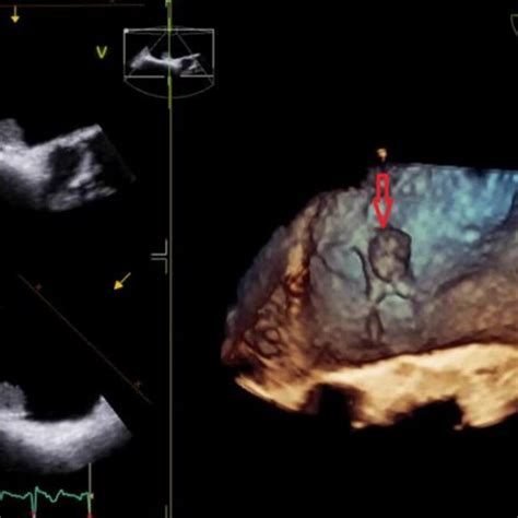 B Three Dimensional Transesophageal Echocardiography Left Atrial Tumor Download Scientific
