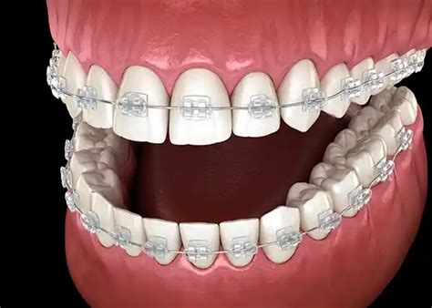 Orthodontist Raleigh Nc What Types Of Braces Are Best For Overbites