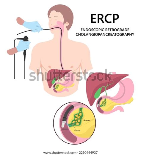 Gallbladder Gallstones Choledocholithiasis Endoscopic Retrograde Cholangiopancreatography Stock