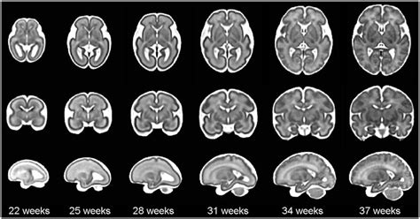 The Spatiotemporal Fetal Brain Mri Atlas Crl Fetal Brain Atlas At Six Download Scientific