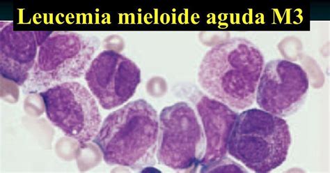 Conoce La Leucemia Mieloide Aguda La Enfermedad Heterogénea E
