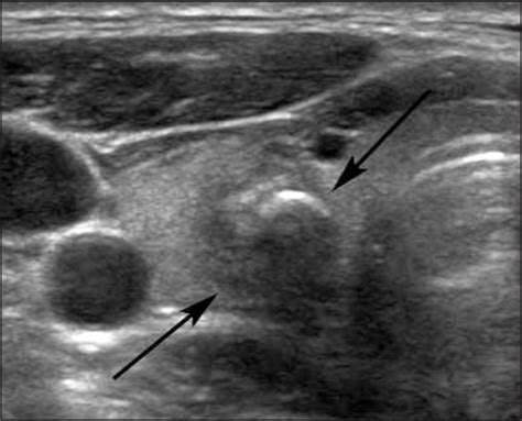 Calcified Thyroid Nodule Ultrasound