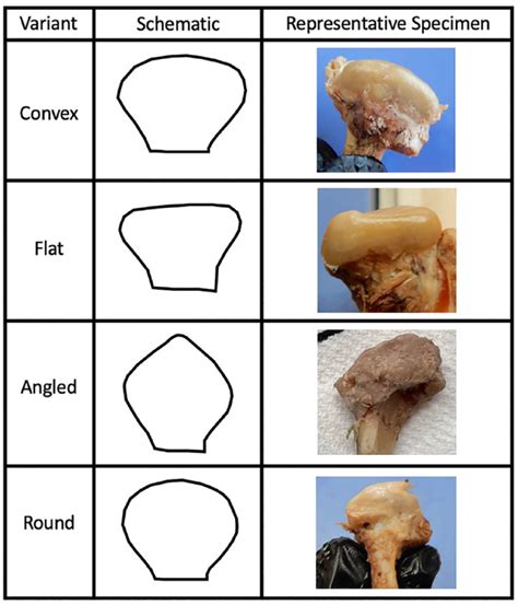 Figure Demonstrates The Variations Of The Mandibular Condyle Drawn In
