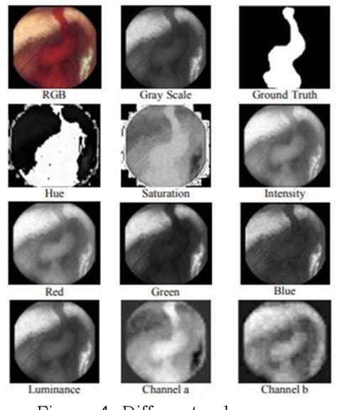 Figure 1 From Rnn Model Based Classification Of Wireless Capsule Endoscopy Bleeding Images